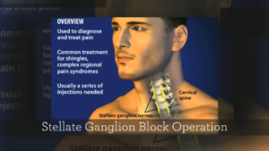 Stellate ganglion block injection – Total Pain Clinic